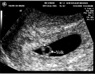 Ticking Clock: 5w5d Ultrasound