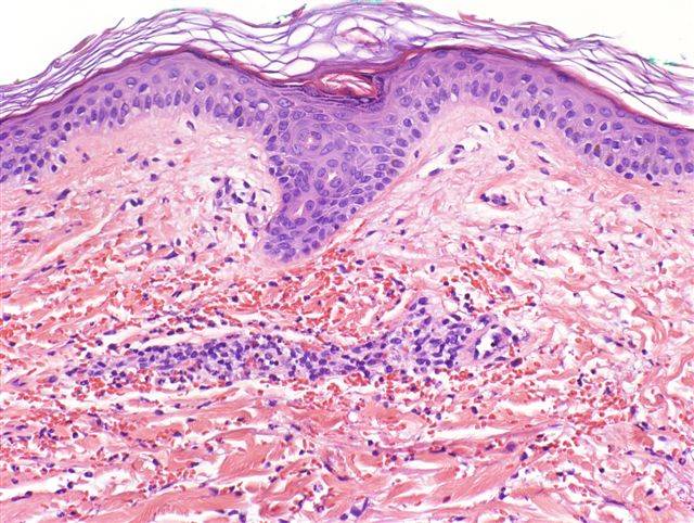 VIRTUAL GRAND ROUNDS IN DERMATOLOGY 2.0: 35 yo woman with short history ...