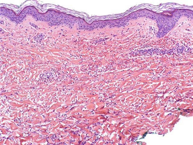 VIRTUAL GRAND ROUNDS IN DERMATOLOGY 2.0: 35 yo woman with short history ...