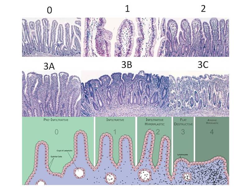VIRCHOW'S EYE: MARSH CLASSIFICATION - CELIAC DISEASE