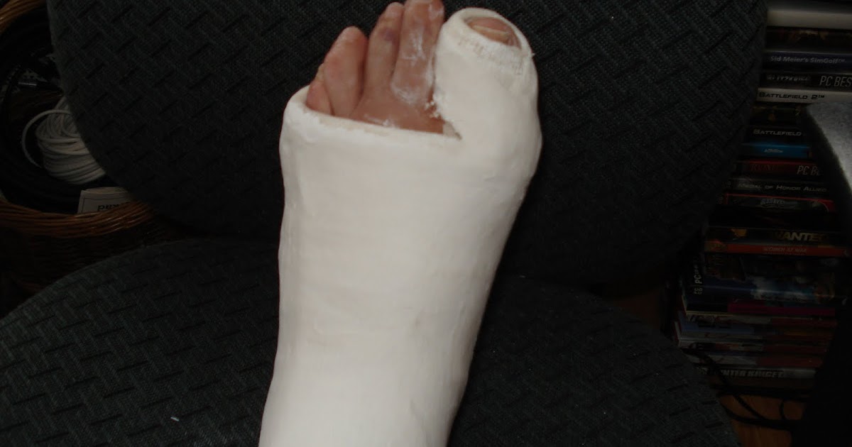 Irenes knitting: Nytt gips idag. ( Got a new cast today.)