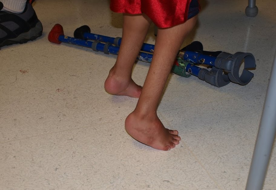 Caudal Regression Syndrome/Sacral Agenesis: Serial Casting: Weeks 1 and 2