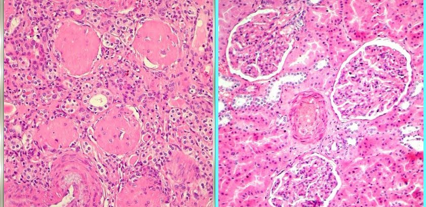 Rim e sistema coletor: Glomerulonefrite esclerosante( Crônica) X Rim normal