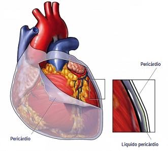 Patologia de Órgãos e Sistemas: PERICARDITE AGUDA