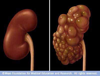 Health Perfect: Kidney Cysts – Information on Kidney Cysts