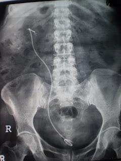 Ramayya Pramila Urology Hospital: Mini PCNL