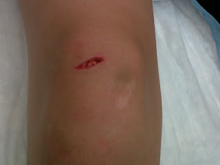 PORTLAND PARKVOLDS: Not for a Weak Stomach - Joel's Gash in His Knee