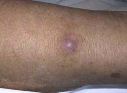 PATOLOGIA BUCAL 30M1: Lesiones elementales (nódulo)